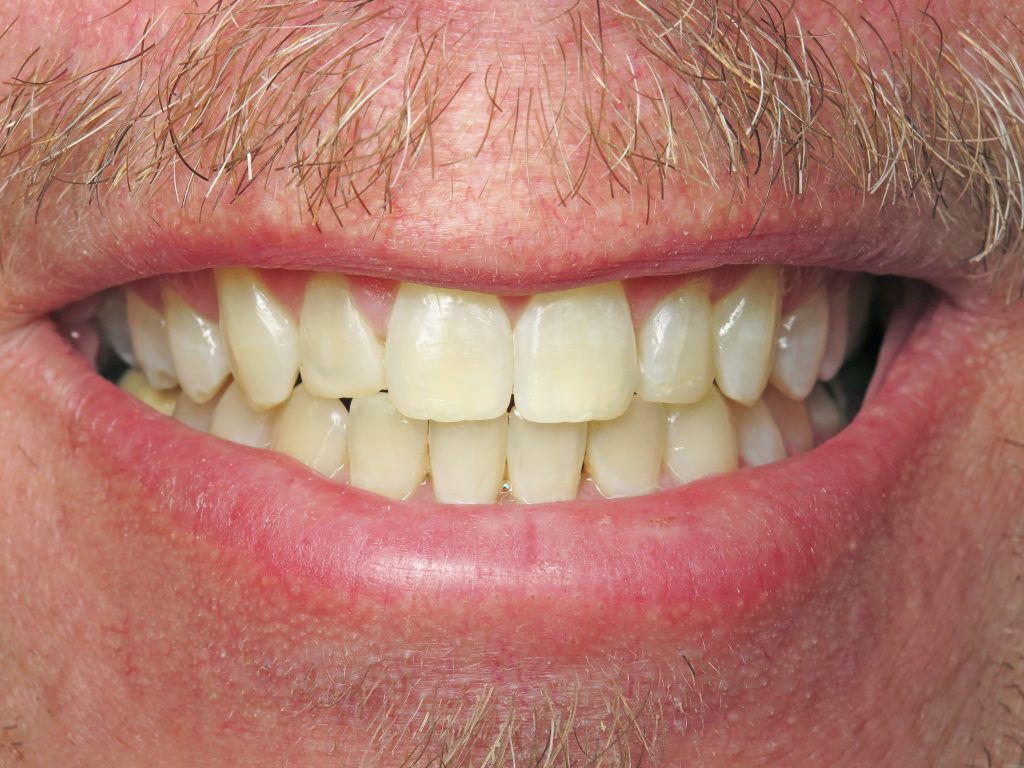 Smile Gallery - Mint Leaf Dental
