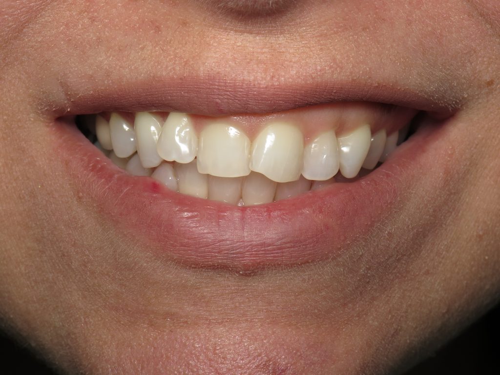 Smile Gallery - Mint Leaf Dental