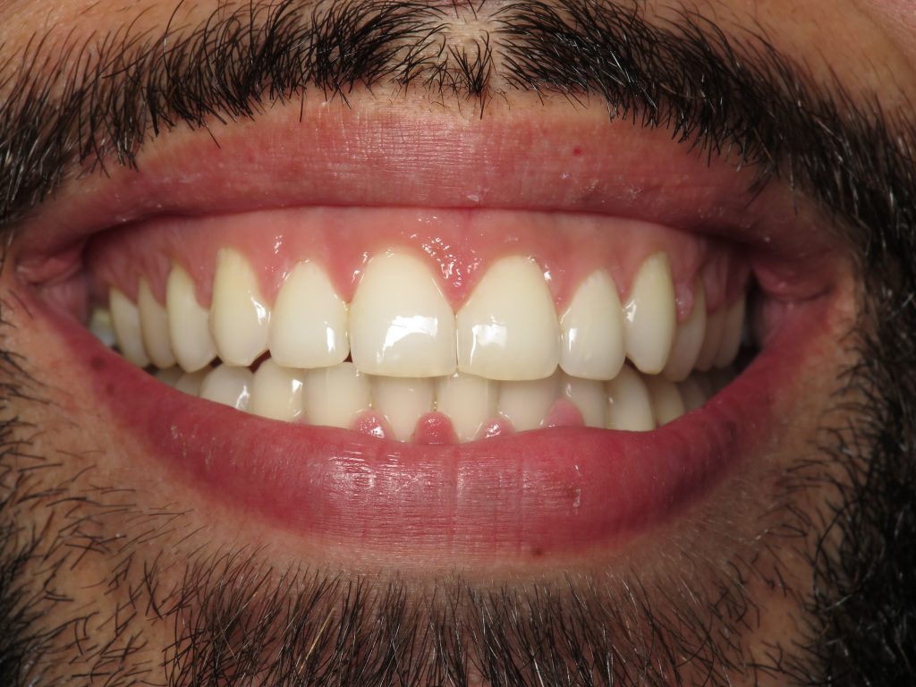 Smile Gallery - Mint Leaf Dental