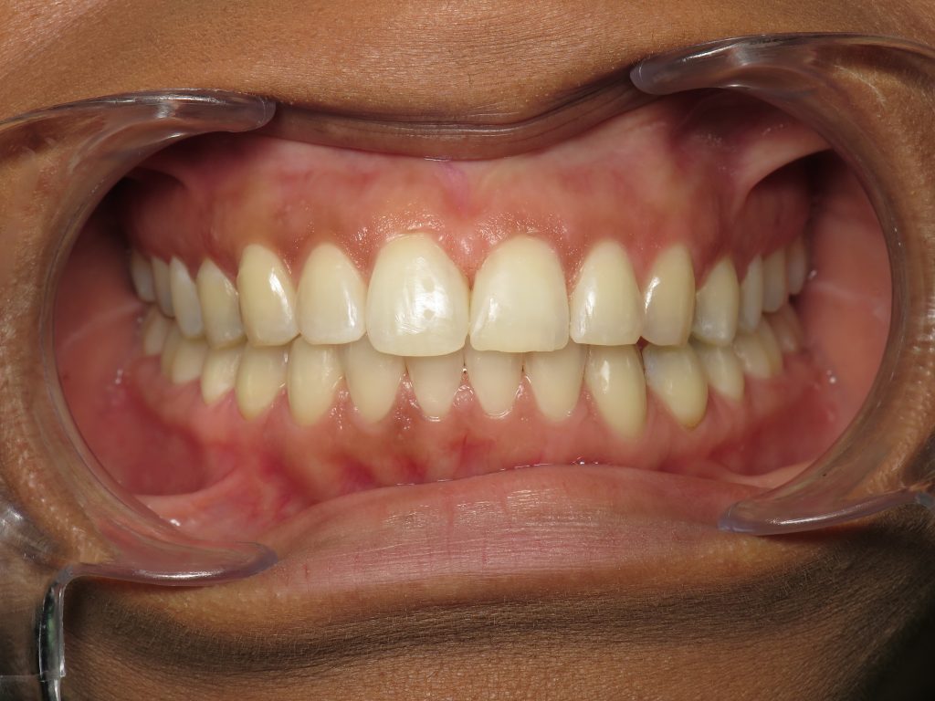Smile Gallery - Mint Leaf Dental