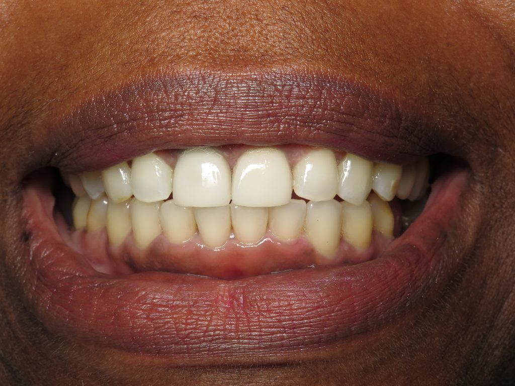 Smile Gallery - Mint Leaf Dental